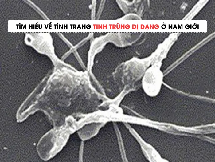 Tìm hiểu về tình trạng tinh trùng dị dạng ở nam giới