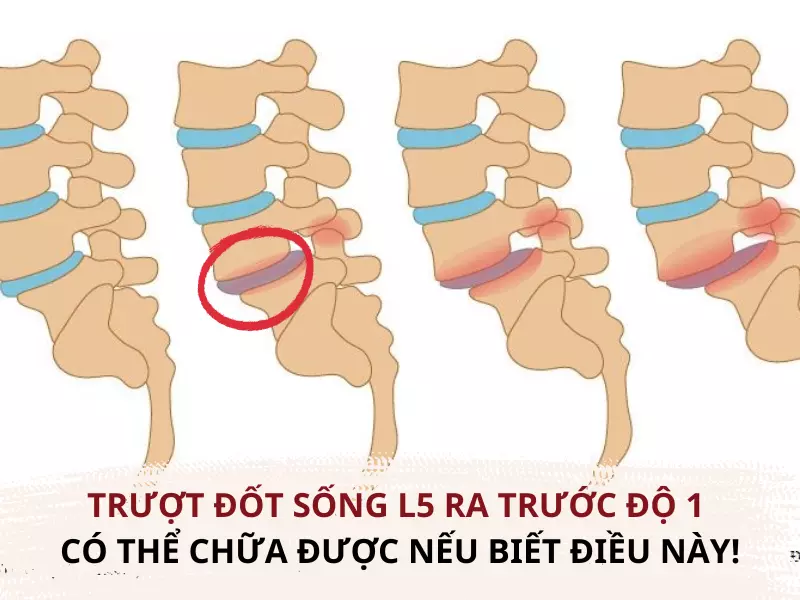 Bị trượt đốt sống L5 ra trước độ 1 có chữa được không?