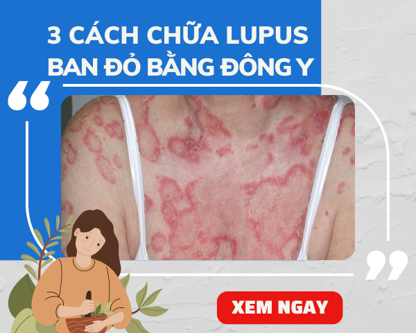 Tiết lộ 3 cách chữa lupus ban đỏ bằng Đông y cực đơn giản
