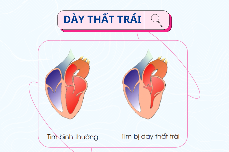 Dày thất trái là gì? Đó có phải căn bệnh nguy hiểm?